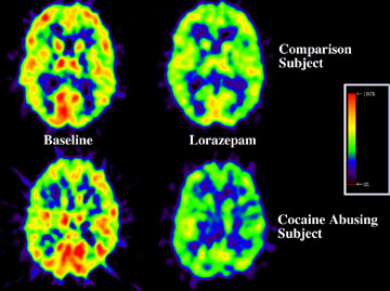 Addiction: A Disease or a Choice? – Cobbers on the Brain