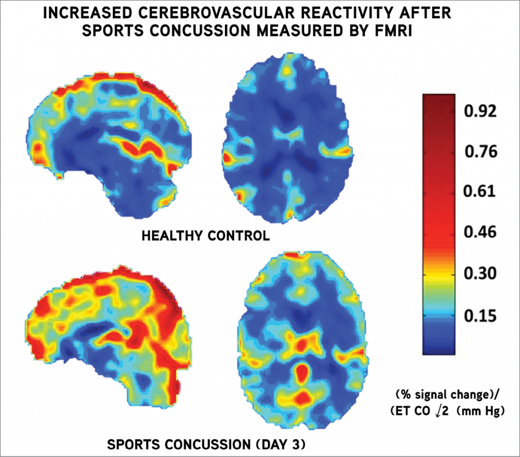 Concussion Background and Visual Imaging – Cobbers on the Brain