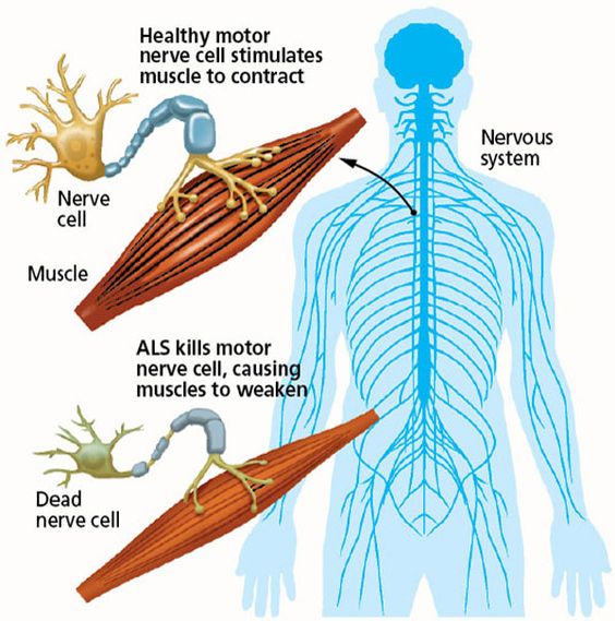 ALS: Bringing Awareness to This Neurodegenerative Disease – Cobbers on ...