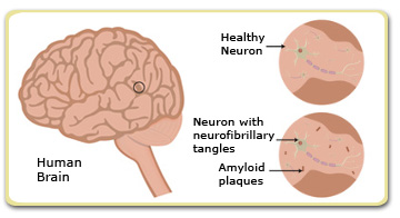 Insulin and Alzheimer’s: Bridging the Link Between Degeneration, Diet ...