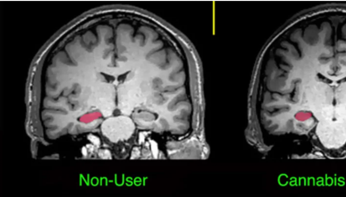 How Does Marijuana Affect the Adolescent Brain? – Cobbers on the Brain