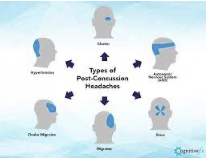Pathophysiology of Symptoms after a Concussion – Cobbers on the Brain