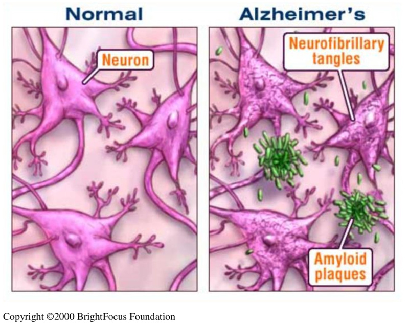 Preventing Insulin Resistance in Alzheimer’s Through Diet – Cobbers on ...