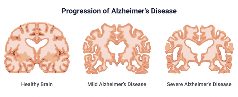 The Hidden Link Between Insulin, Brain Health, and Memory Loss ...
