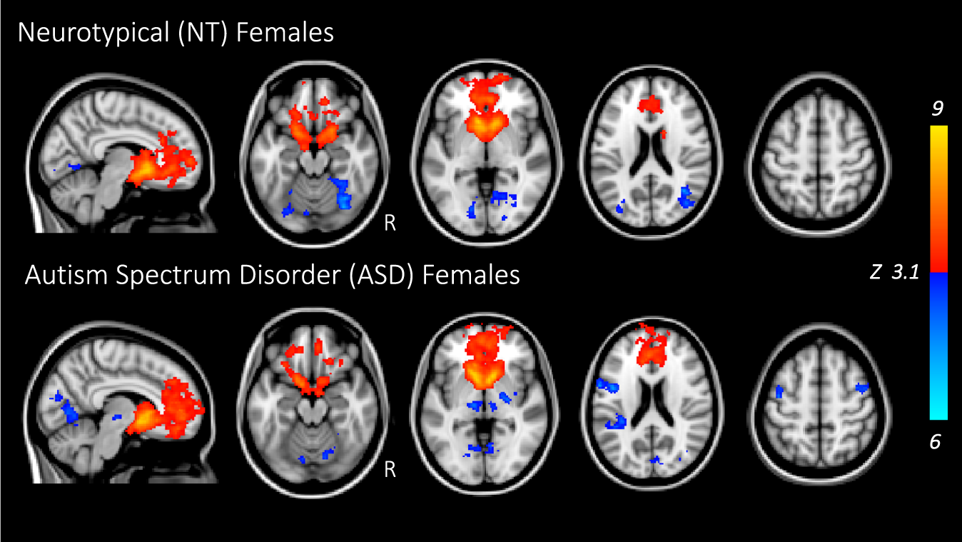Dopamine – Have Researchers Found the Missing Piece to the Autism ...