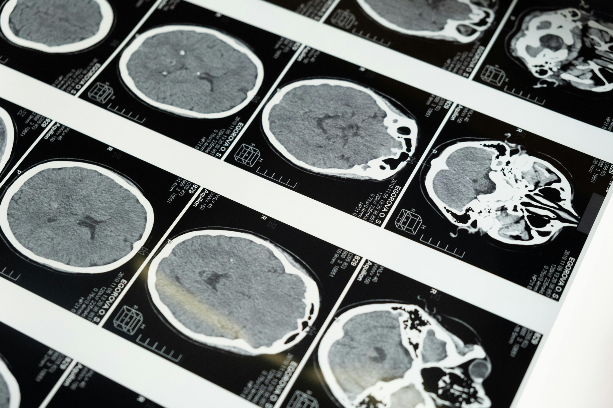 More Than a Bump: What Really Happens in the Brain After a Concussion ...